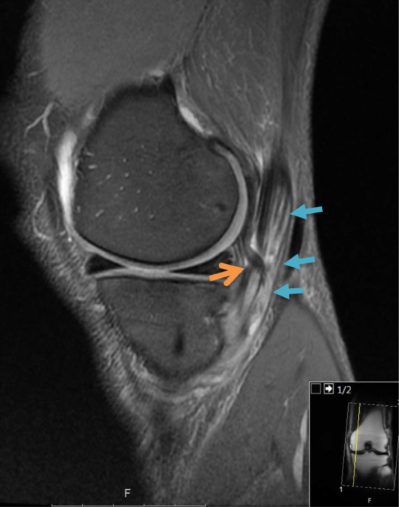 An anomalous band originating from the fabella causing semimembranosus ...