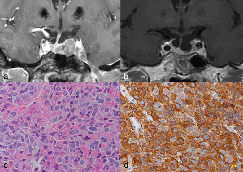 Early surgical intervention for patients with possible clinically ...