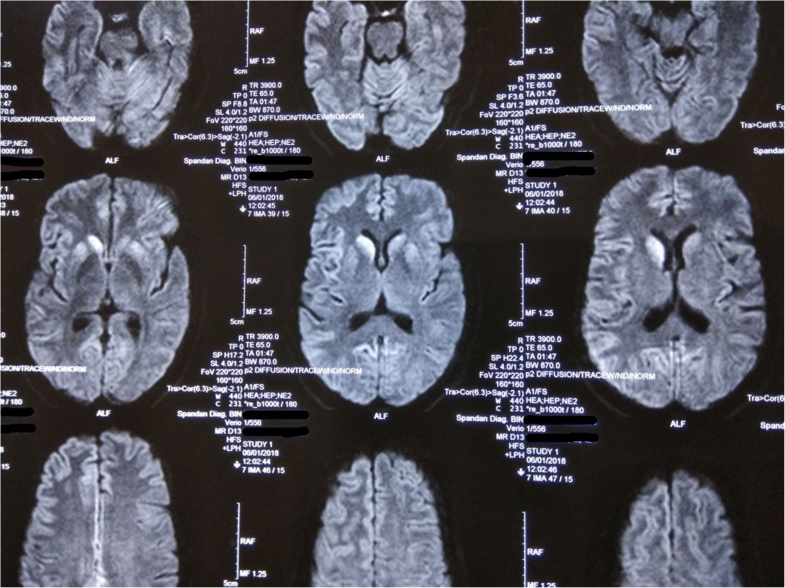Young-onset sporadic Creutzfeldt–Jakob disease with atypical phenotypic ...