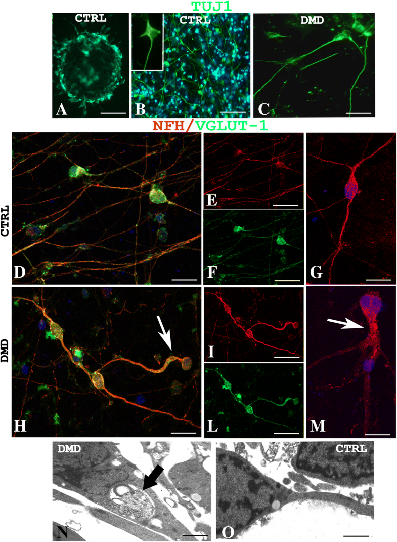 DP71 and SERCA2 alteration in human neurons of a Duchenne muscular ...