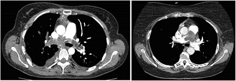 Presentation and management of pulmonary artery sarcoma | Clinical ...