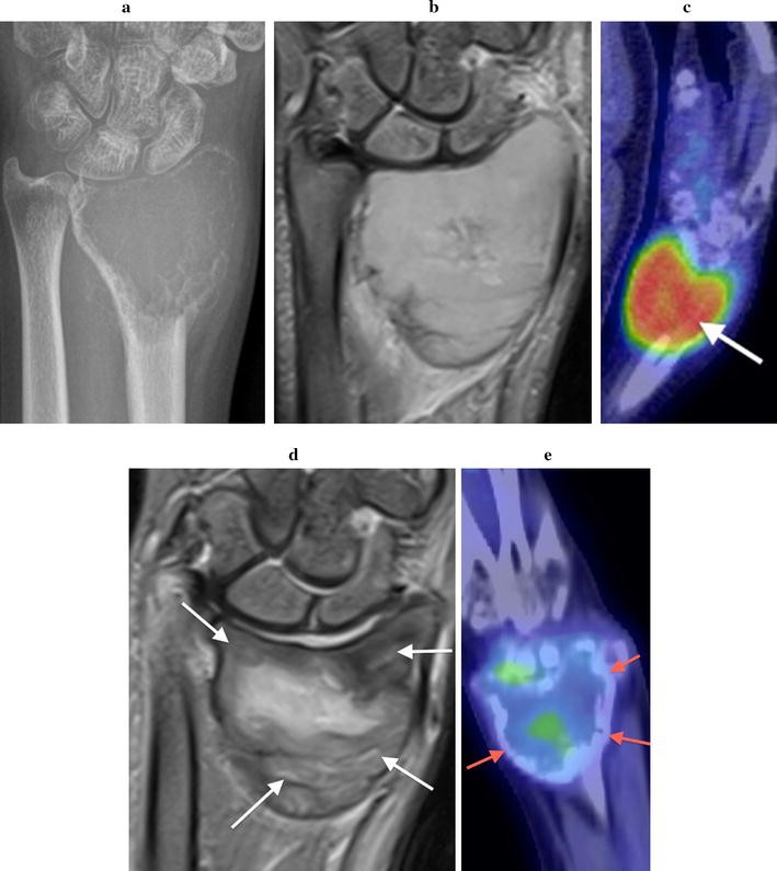 Giant cell tumour of the distal radius/ulna: response to pre-operative ...