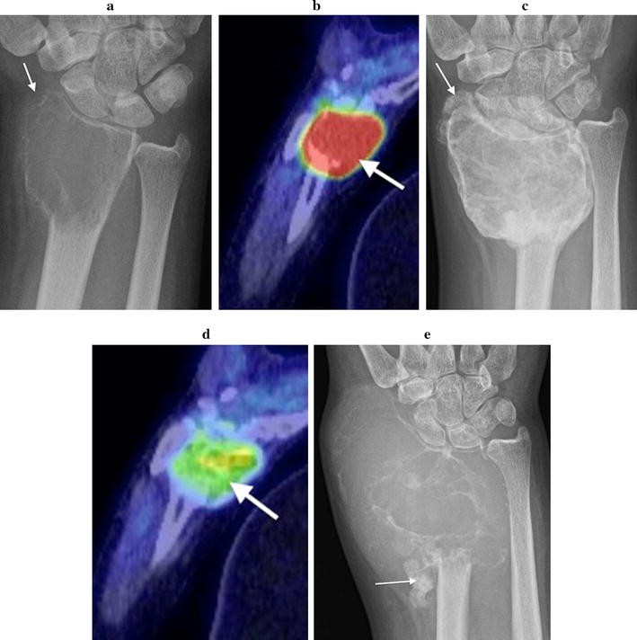 Giant cell tumour of the distal radius/ulna: response to pre-operative ...