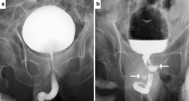 Abnormal 18F-FDG uptakes in the prostate due to two different ...