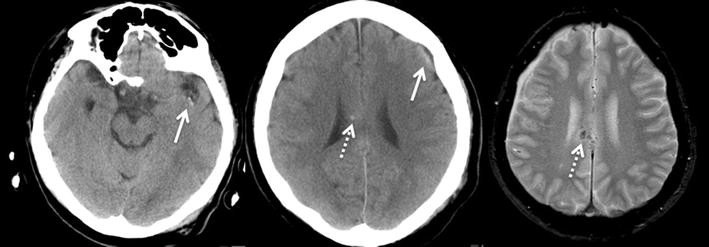 Canadian CT head rule and New Orleans Criteria in mild traumatic brain ...
