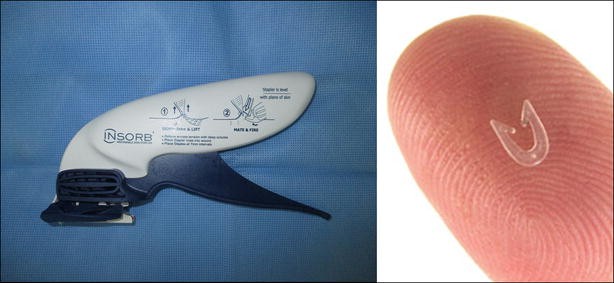 Donor-site closure using absorbable dermal staple for deep inferior ...