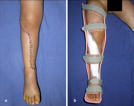 Proximal tibial reconstruction with auto transplantation of the fibular ...