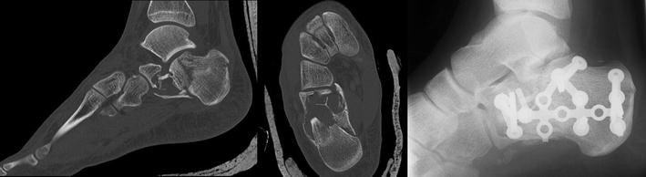 Endoscopic resection and allografting for benign osteolytic lesions of ...