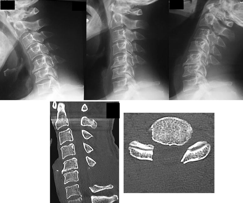 Cervical myelopathy due to a solitary osteochondroma: a case report ...