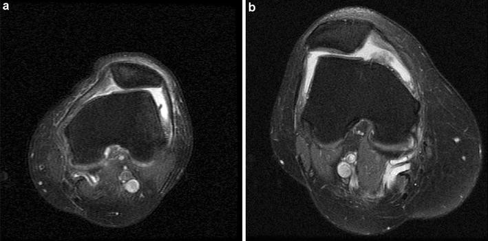 Patellar malalignment: a new method on knee MRI | SpringerPlus | Full Text