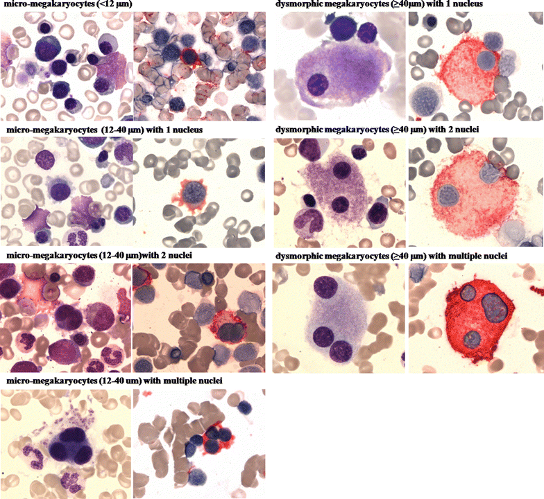 A systematic classification of megakaryocytic dysplasia and its impact ...