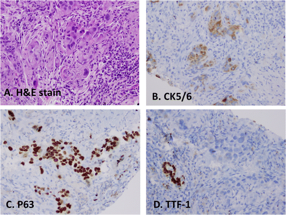 Utility of five commonly used immunohistochemical markers TTF-1, Napsin ...