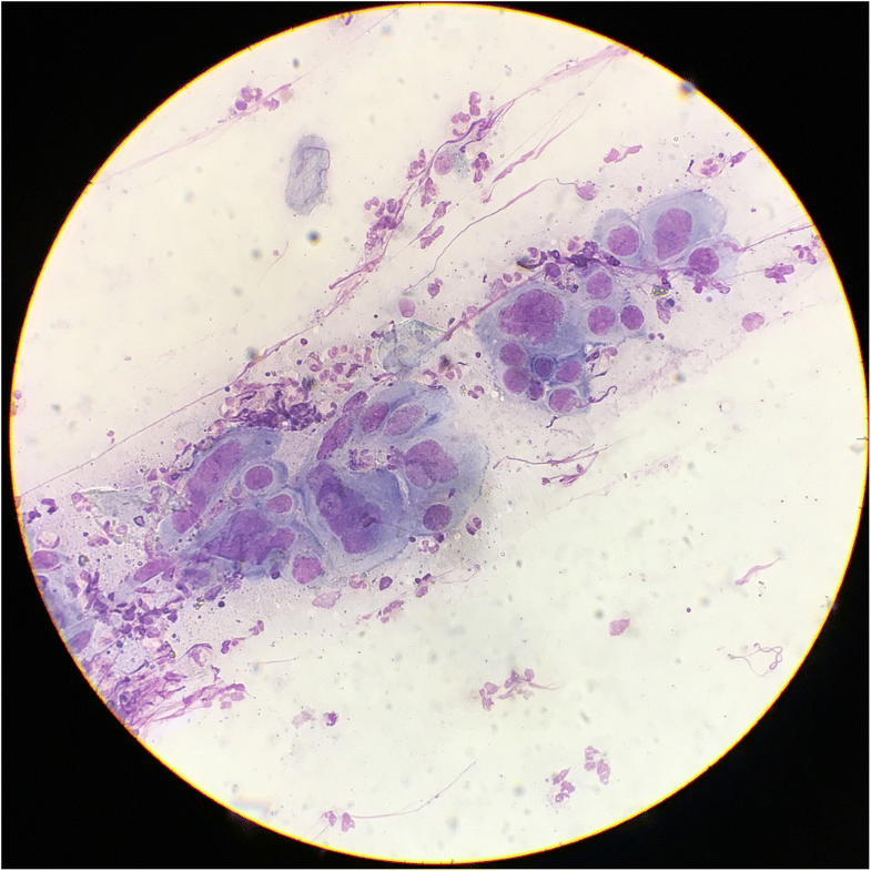Kaposi’s varicelliform eruption in a patient with metastatic melanoma ...