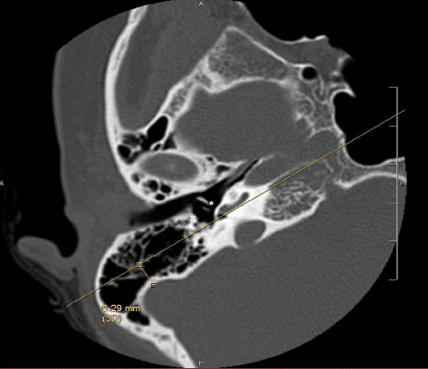 Predictors of round window accessibility for adult cochlear ...