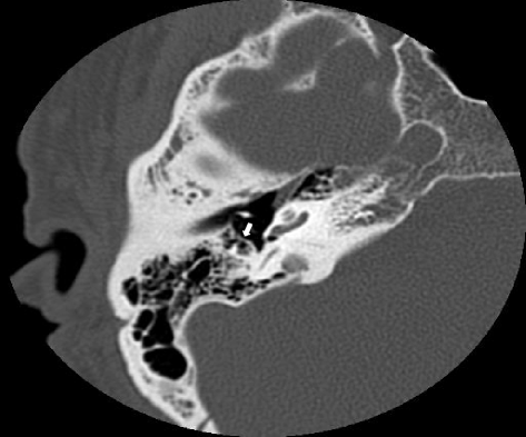 Predictors of round window accessibility for adult cochlear ...