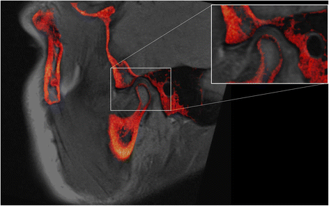 MRI and CBCT image registration of temporomandibular joint: a ...