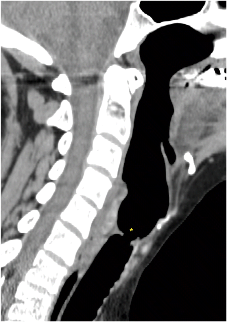 Successful ventilation through a Rüsch intubation guide catheter in ...