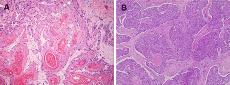 The molecular mechanisms of increased radiosensitivity of HPV-positive oropharyngeal squamous ...