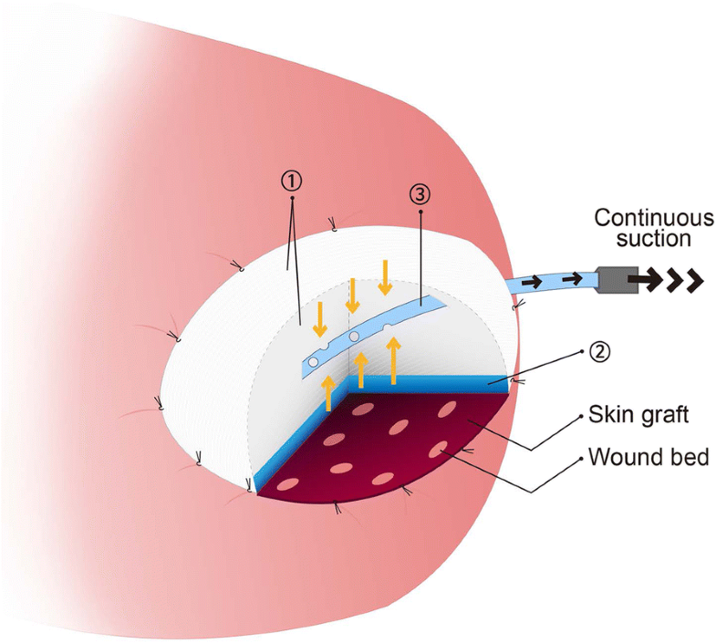 Modified bolster dressing with continuous suction improves skin graft ...