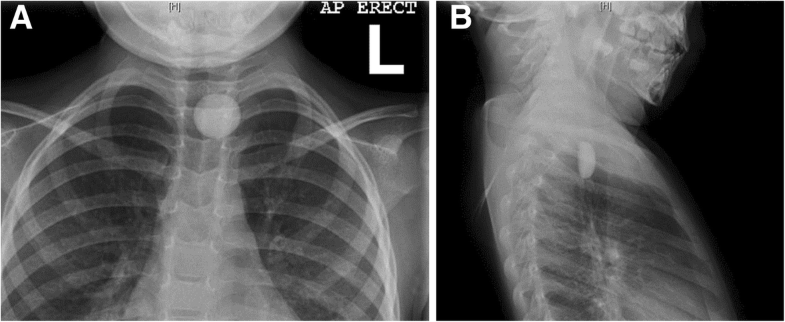 Double Fogarty balloon catheter technique for difficult to retrieve ...