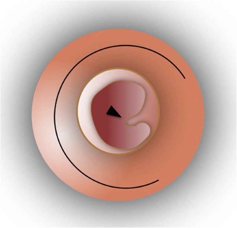Loop underlay tympanoplasty for anterior, subtotal and total tympanic ...