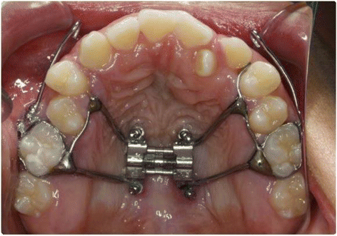 The efficacy of maxillary protraction protocols with the micro-implant ...