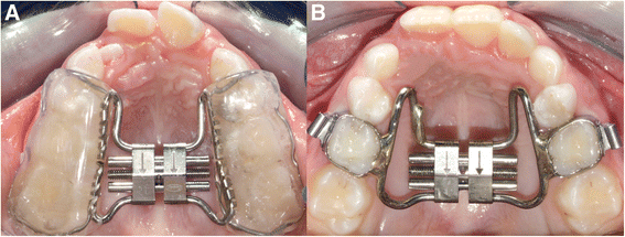 Mandibular response after rapid maxillary expansion in class II growing ...