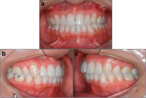 Dentoskeletal and soft tissue changes in class II subdivision treatment ...