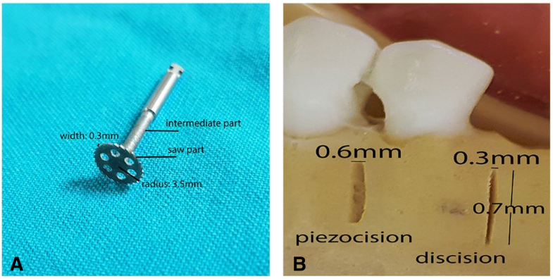 Comparison of piezocision and discision methods in orthodontic treatment | Progress in ...