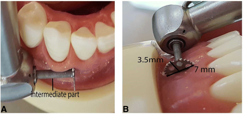 Comparison of piezocision and discision methods in orthodontic ...