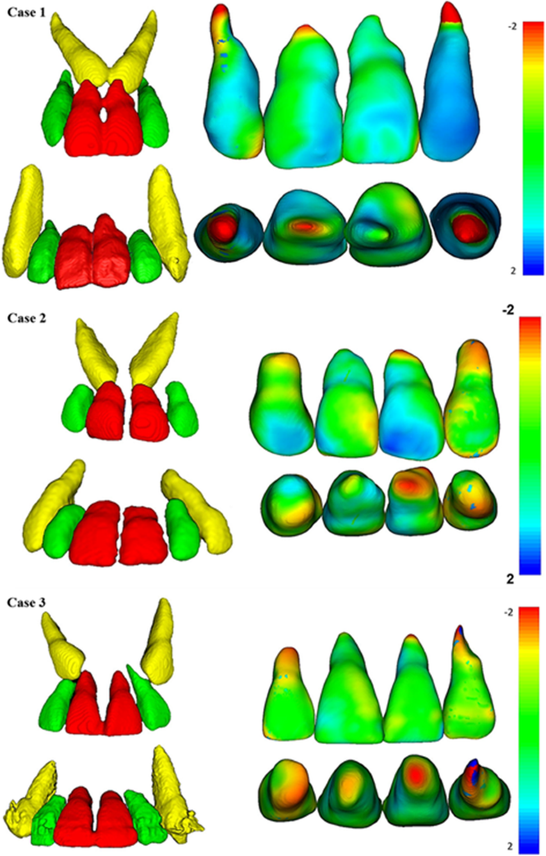 Three-dimensional evaluation of the root resorption of maxillary incisors after the orthodontic ...