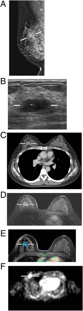 Computer-aided detection (CAD) system for breast MRI in assessment of local tumor extent, nodal ...
