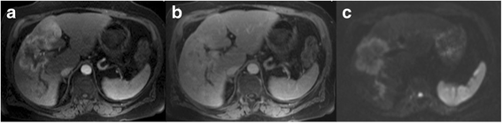 LI-RADS v2017 for liver nodules: how we read and report | Cancer ...