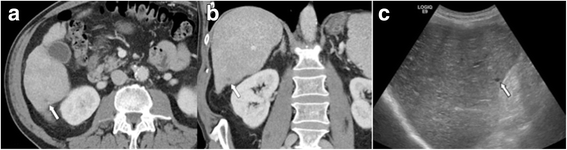 LI-RADS v2017 for liver nodules: how we read and report | Cancer ...