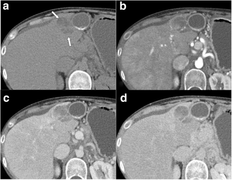 LI-RADS v2017 for liver nodules: how we read and report | Cancer ...