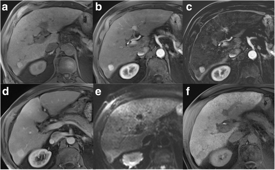 LI-RADS v2017 for liver nodules: how we read and report | Cancer ...