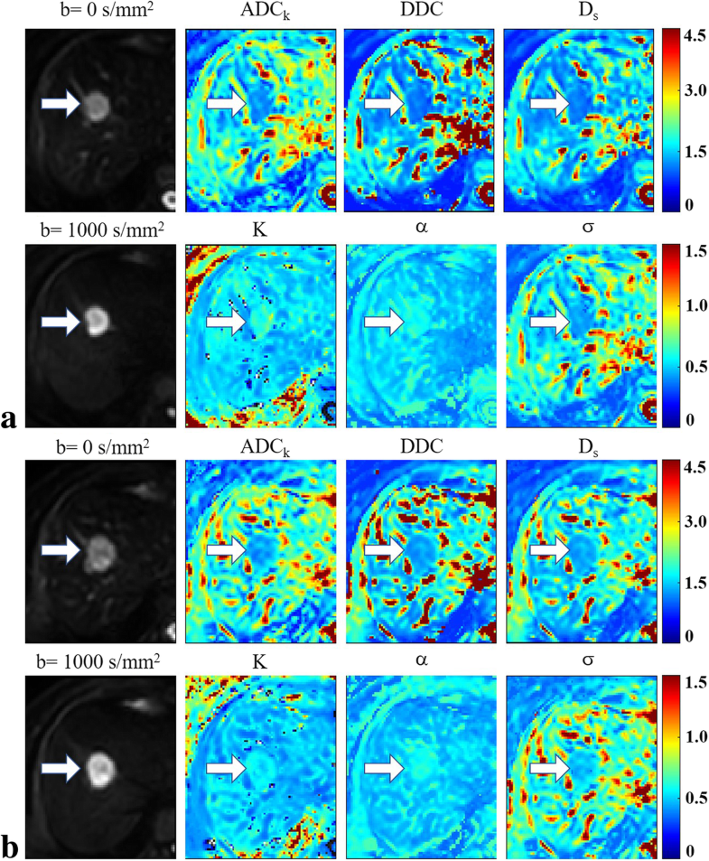 Non-mono-exponential diffusion models for assessing early response of ...