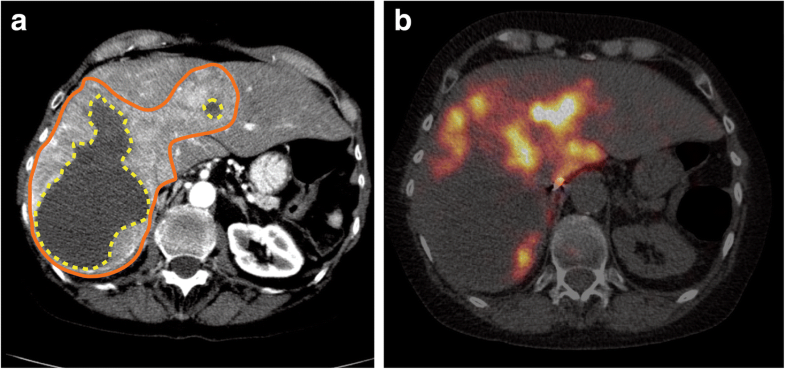 The physics of radioembolization | EJNMMI Physics | Full Text