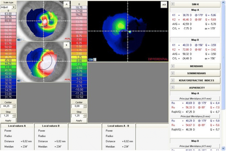 The use of intracorneal ring segments in keratoconus | Eye and Vision ...