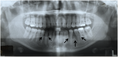 Dental implant treatment in a young woman after marginal mandibulectomy ...