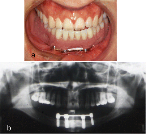 Dental implant treatment in a young woman after marginal mandibulectomy ...