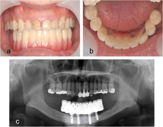 Dental implant treatment in a young woman after marginal mandibulectomy ...