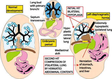 Congenital Diaphragmatic hernia – a review | Maternal Health ...