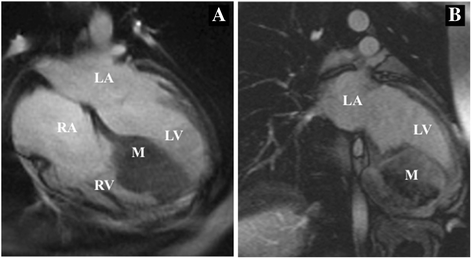 Successful surgical treatment for recurrent cardiac fibroma 21 years ...