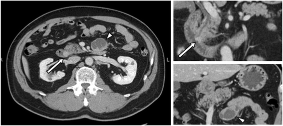Neuroendocrine tumor of the ampulla of Vater with distant cystic lymph ...