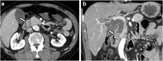 Undifferentiated carcinoma of the ampulla of Vater | Surgical Case ...