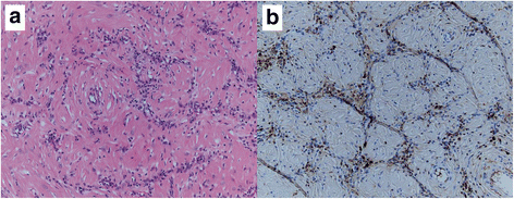 Radical resection of a giant retroperitoneal calcifying fibrous tumor ...
