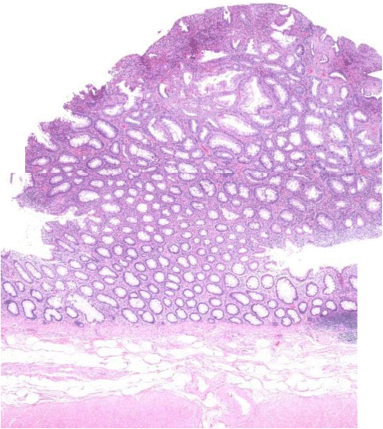Successful laparoscopic resection for cap polyposis: case report ...