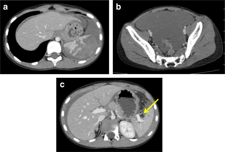 A rare mechanism of delayed splenic rupture following the nonoperative ...