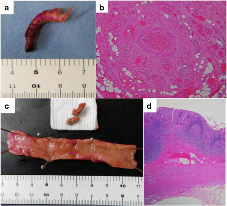 Laparoscopic treatment of intestinal obstruction due to a vitelline ...
